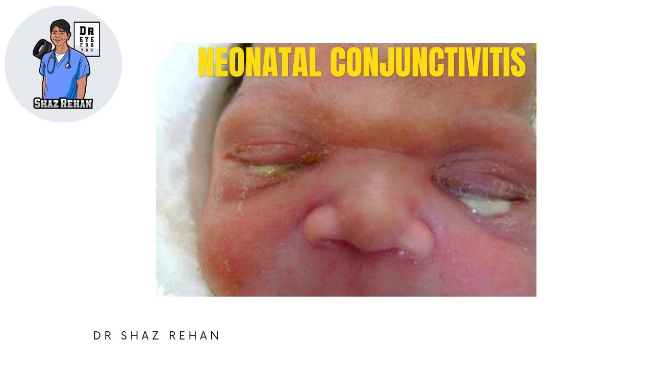 Neonatal Conjunctivitis. Is it SERIOUS? Eye Dr Explains. - YouTube