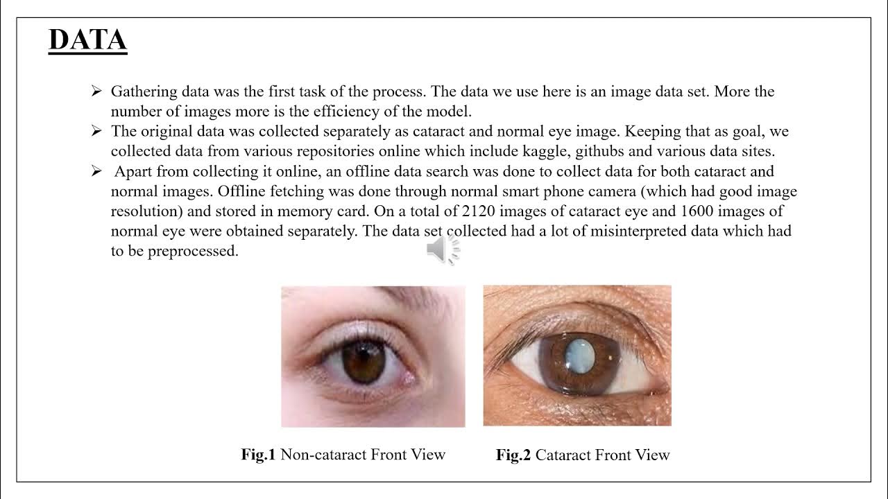 74 Automated Detection Of Cataract Using Deep Learning Technique Youtube