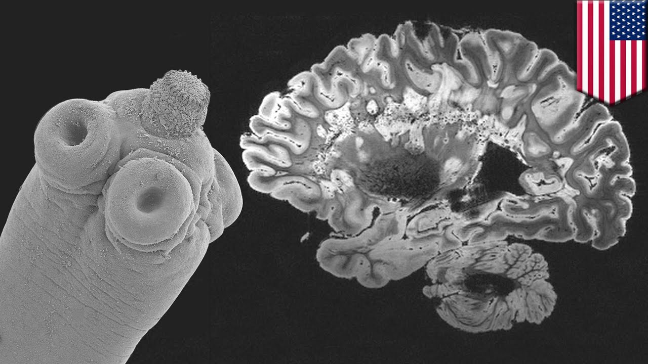 Woman's suspected brain tumor is actually a parasite - TomoNews - YouTube