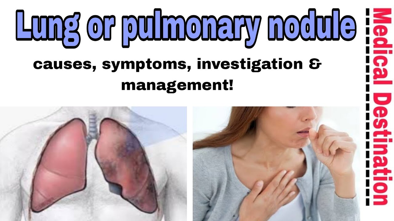 Lungs nodule| causes | symptoms | investigation & treatment in hindi ...
