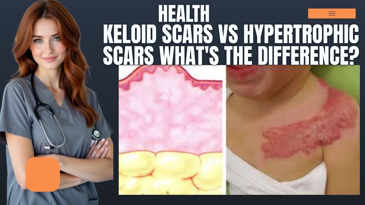 Keloid and hypertrophic scar - YouTube