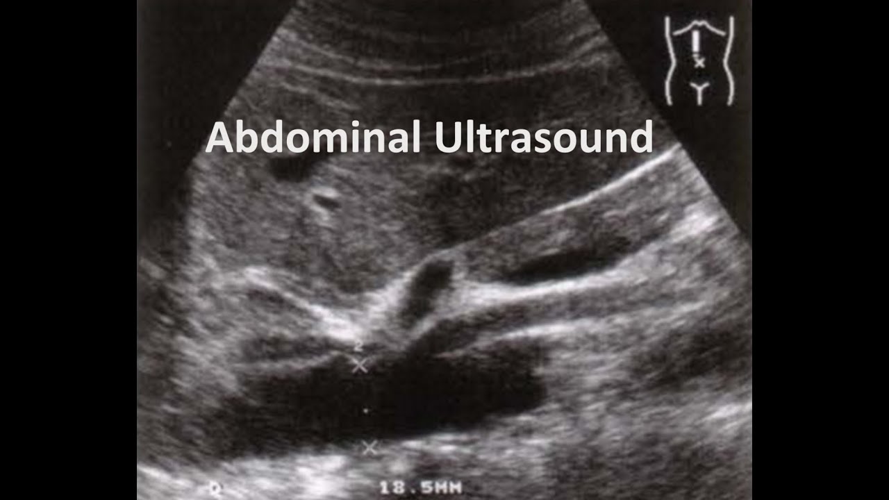 Ultrasound Anatomy- Abdominal Sagittal Cross section - YouTube
