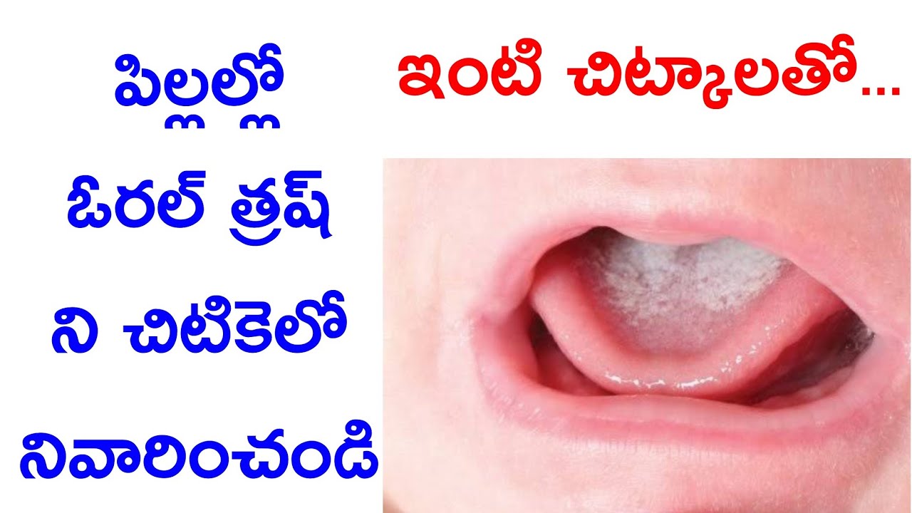 canker sores in children / Tongue ulcers in children / noti putha ki ...