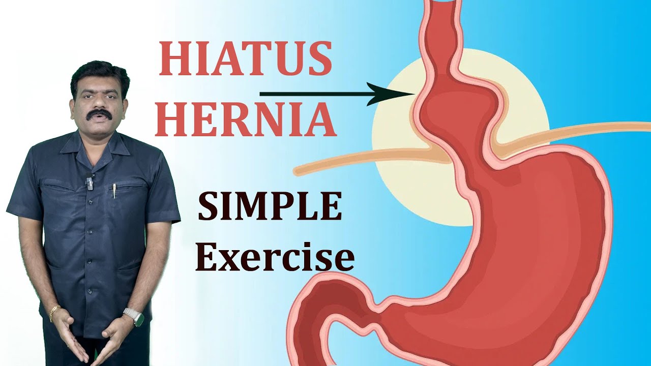 குடலேற்றம் சரி செய்வது எப்படி | Hiatus hernia or Hiatal Hernia Simple ...