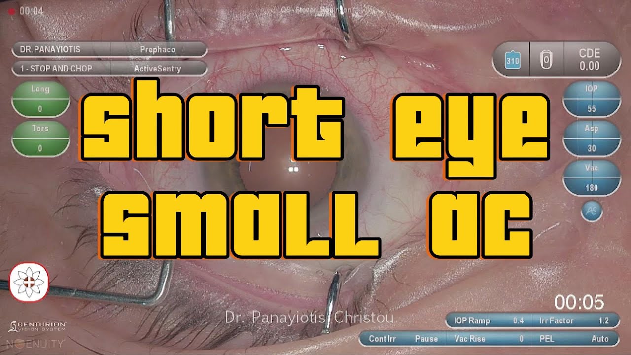 Cataract surgery in small eye, closed angle glaucoma, shallow anterior ...
