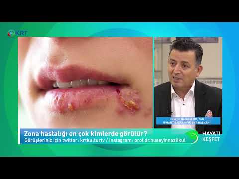 Zona Nedir  Belirtileri Nelerdir? Dr Hüseyin Nazlıkul   Hayatı Keşfet