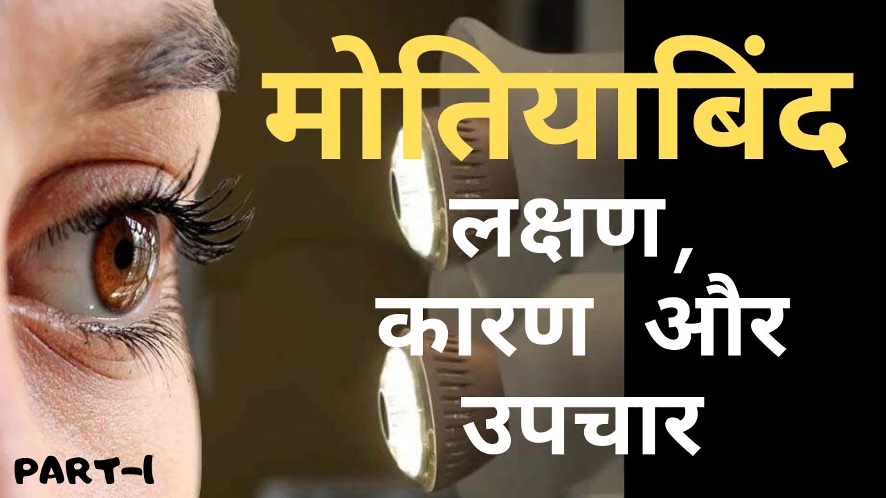 मोतियाबिंद - लक्षण, कारण और उपचार | Cataract - Causes, Symptoms ...