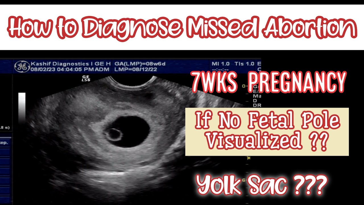 7 wks Miscarriage TVS Ultrasound || How to Diagnose | Role of Yolk sac ...