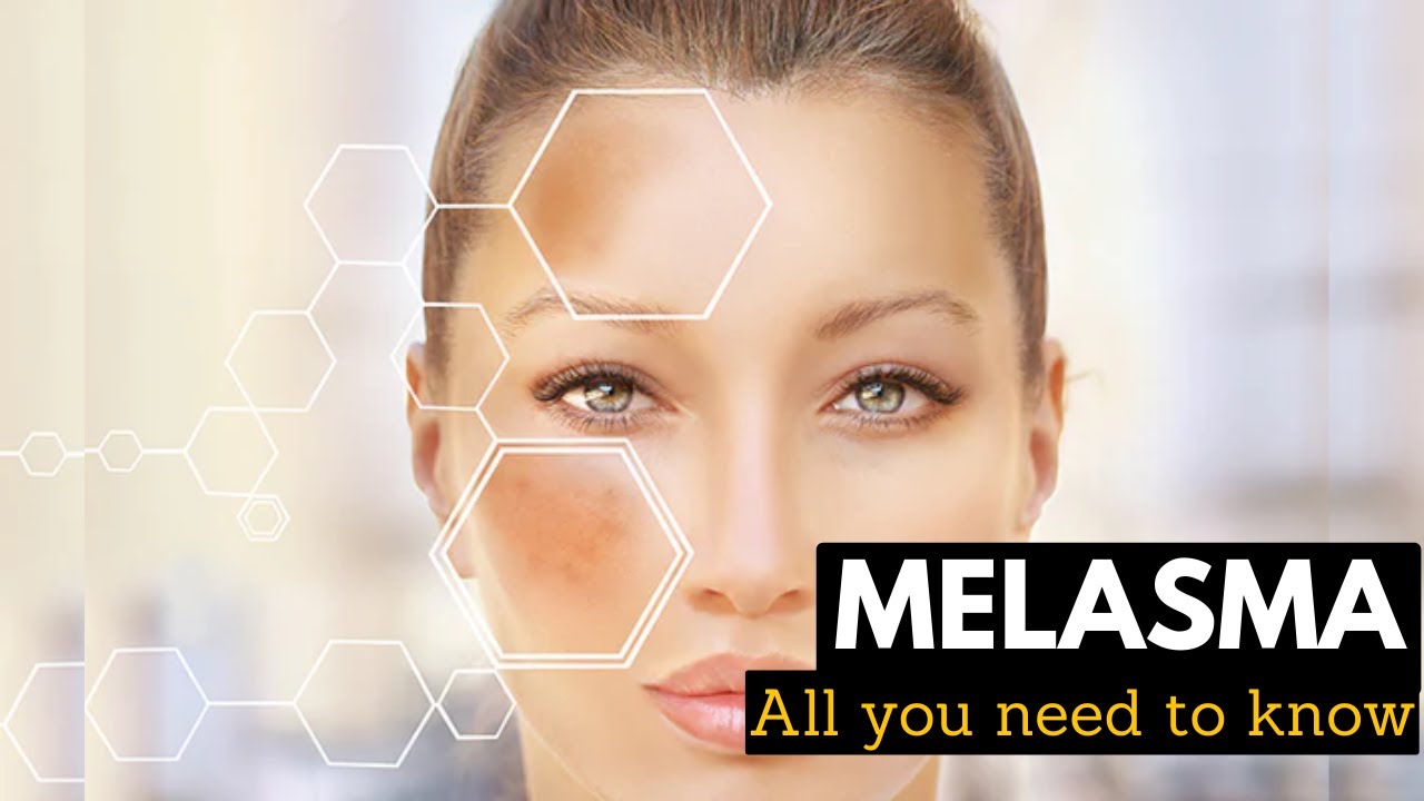 Melasma, Causes, Signs and Symptoms, Diagnosis and Treatment. - YouTube