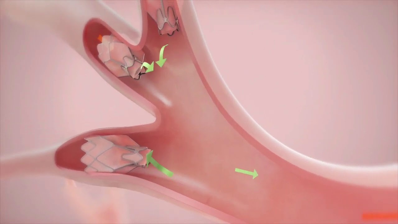 What is a zephyr valve? - Living Healthy with COPD (Latest COPD News ...