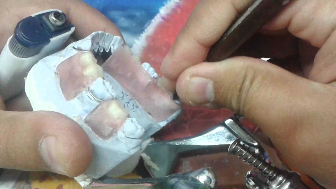 completing the waxing procedure for the design of acrylic RPD - YouTube