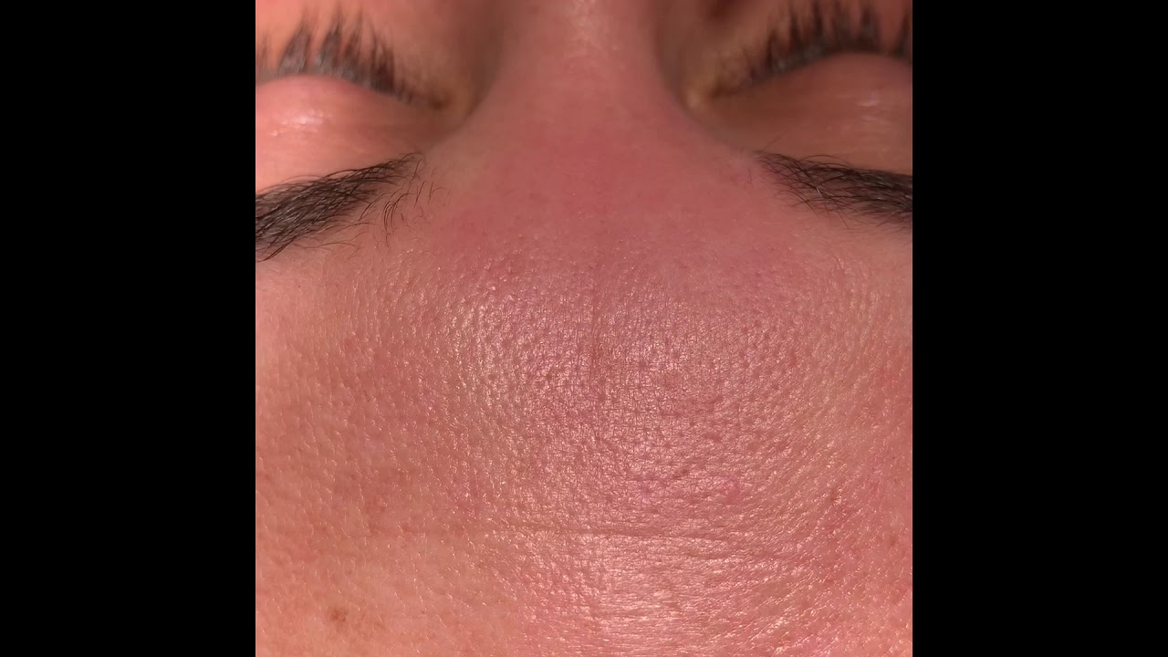 Filler for fine lines between brows also known as 11's - YouTube