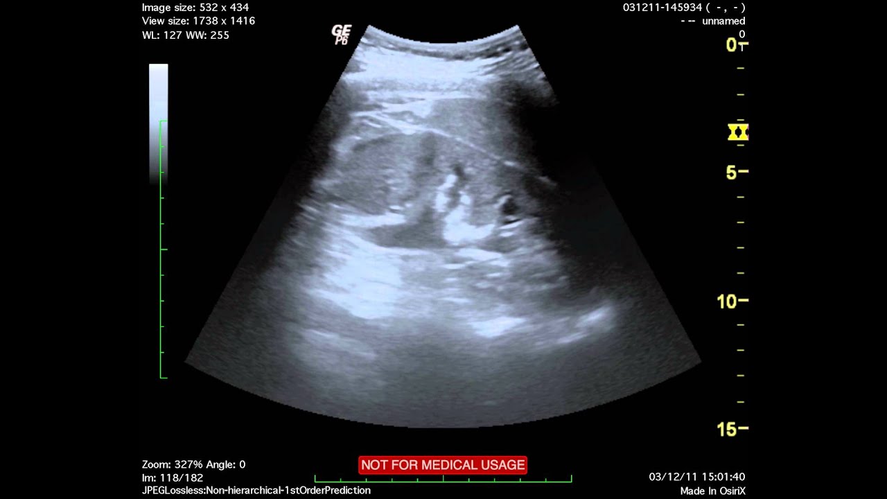 Ecografia renale - YouTube