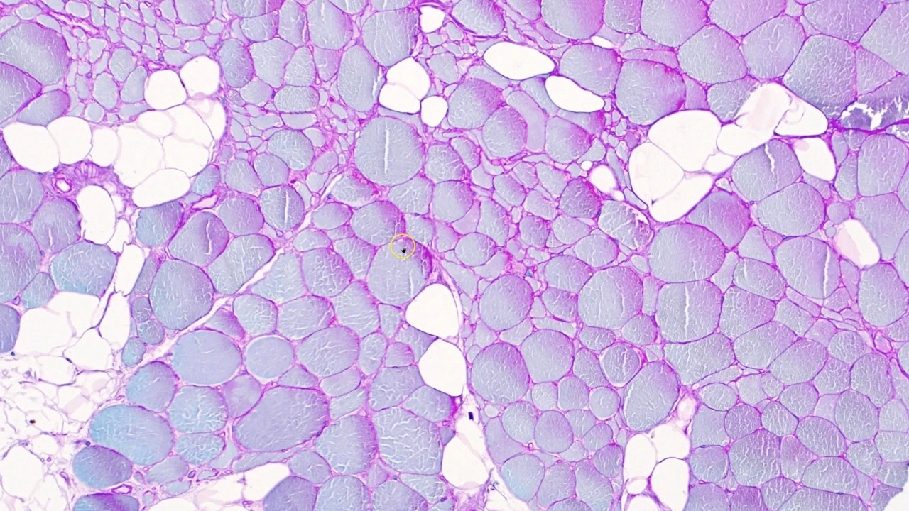 Beautiful pink & green soap bubbles? Nope! Skeletal muscle atrophy on ...