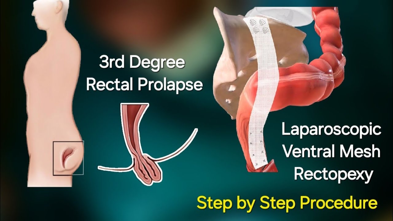Laparoscopic Ventral Mesh Rectopexy | step by step with tips - Dr ...