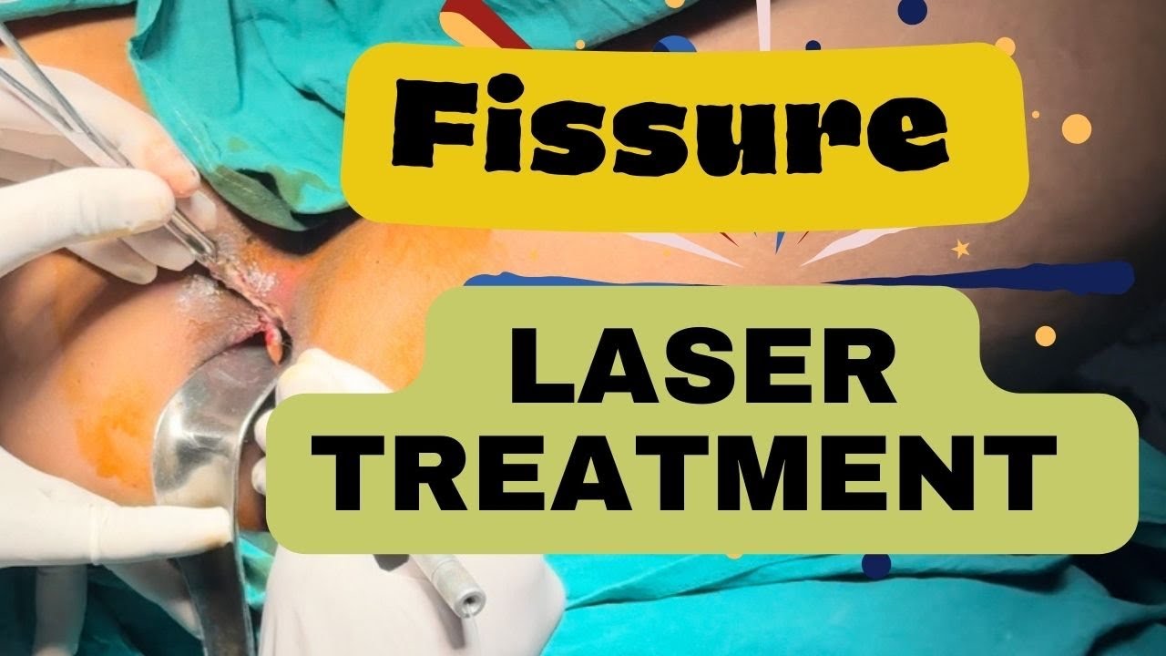 Best Treatment for Fissure by Dr Saurabh in Ahmedabad | laser Treatment ...