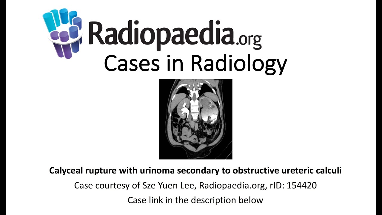 Calyceal rupture with urinoma (Radiopaedia.org) Cases in Radiology ...