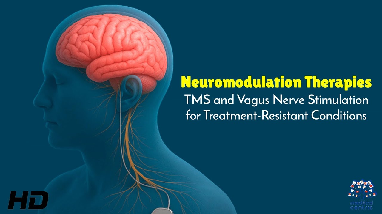 Neuromodulation Therapies : TMS and Vagus Nerve Stimulation for ...