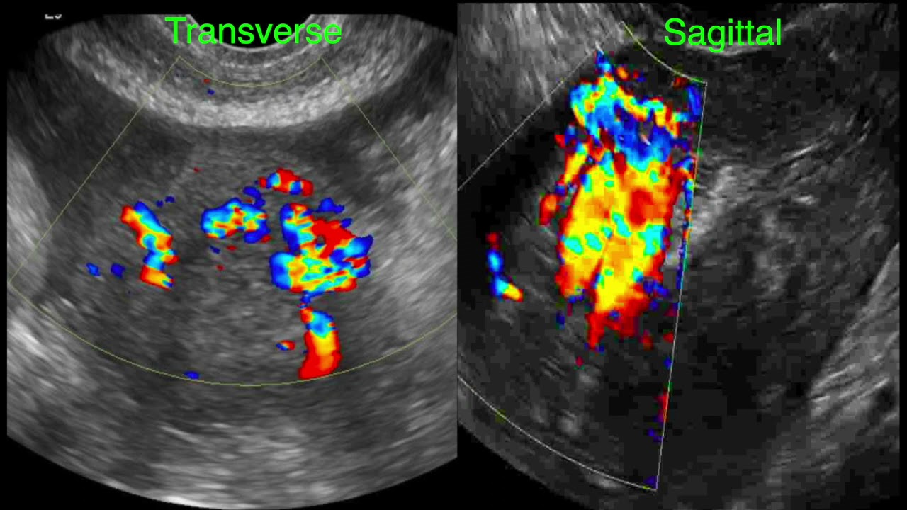 Enhanced Myometrial Vascularity: Case Presentation and Review - YouTube