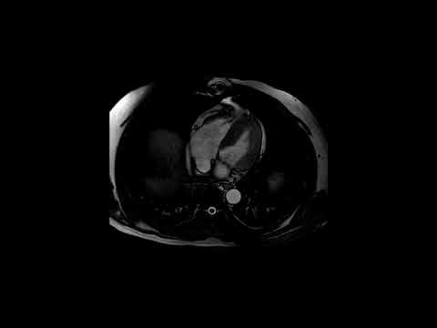 CARDIAC MRI SHOWING LEFT VENTRICULAR TO RIGHT ATRIAL SHUNT - YouTube