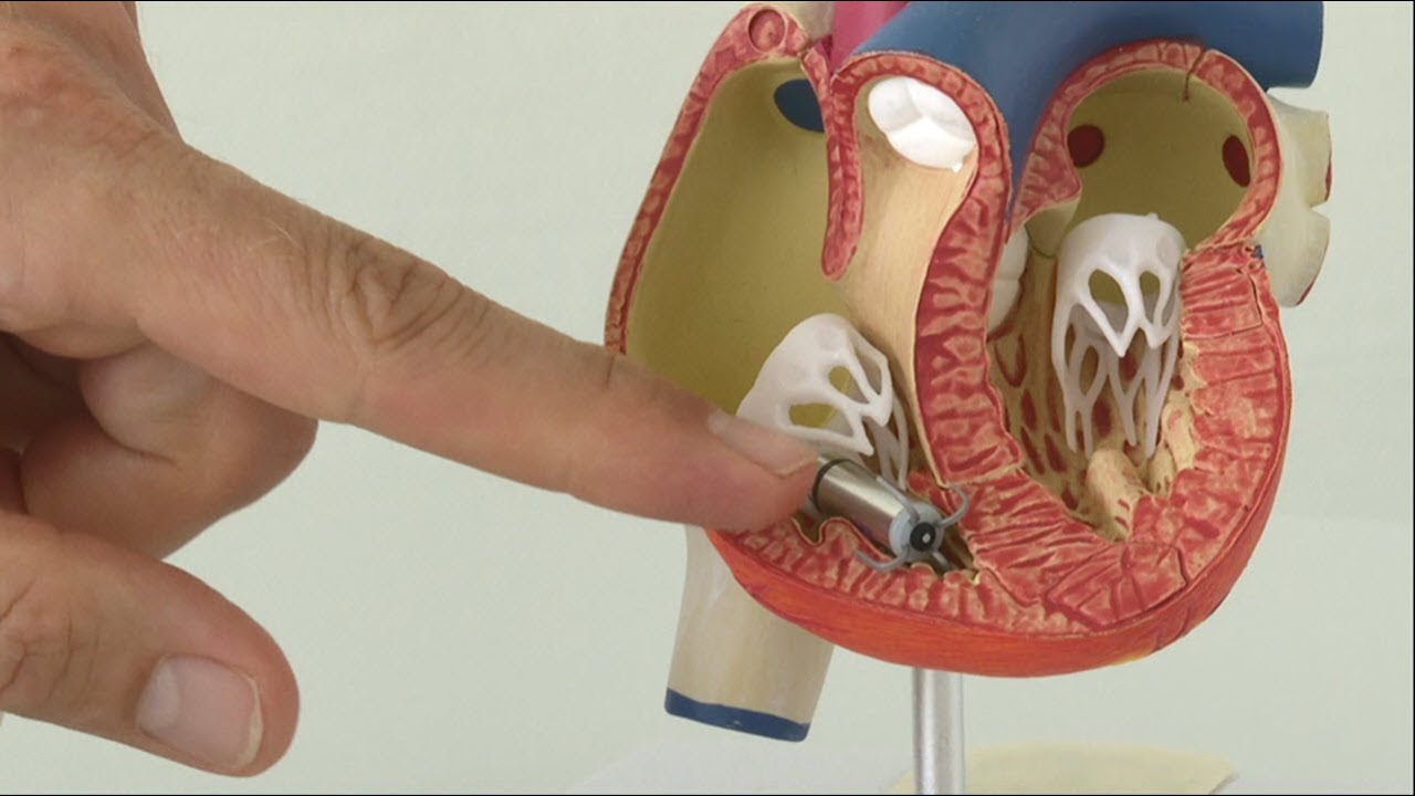 Cardiologie: dernière génération de pacemakers - YouTube