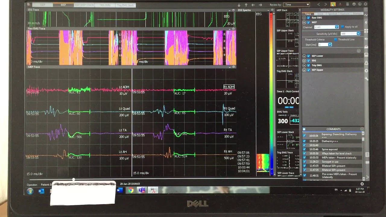 Intraoperative Neuromonitoring - YouTube