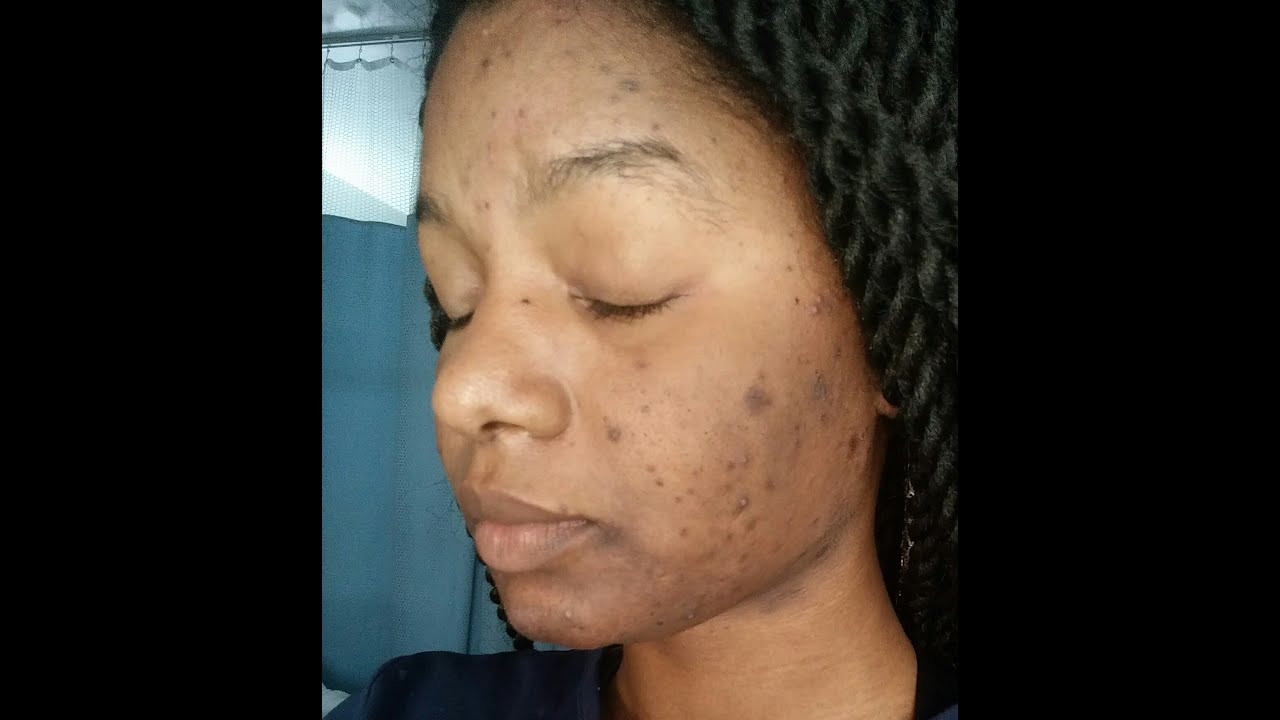 How I Destroyed my Face and Redeemed myself in a month!!! Honest Kojic ...