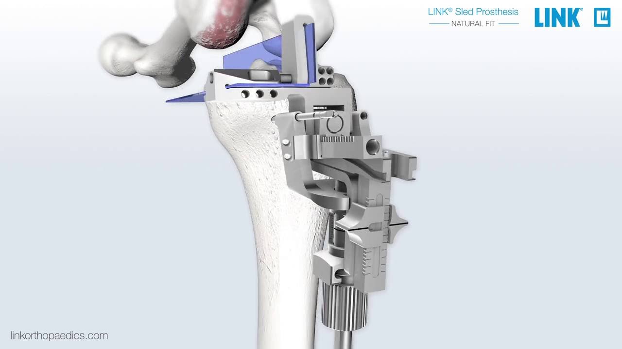 LINK Sled Prosthesis with MITUS ART - Implant & Instruments - YouTube