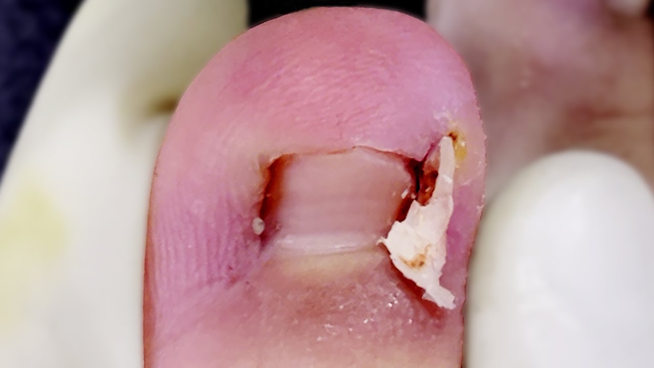 Oversized ingrown toenails penetrated deep into the flesh，ultra short ...