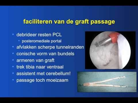 A helping hand in dealing with the killer turn angles in PCL surgery ...