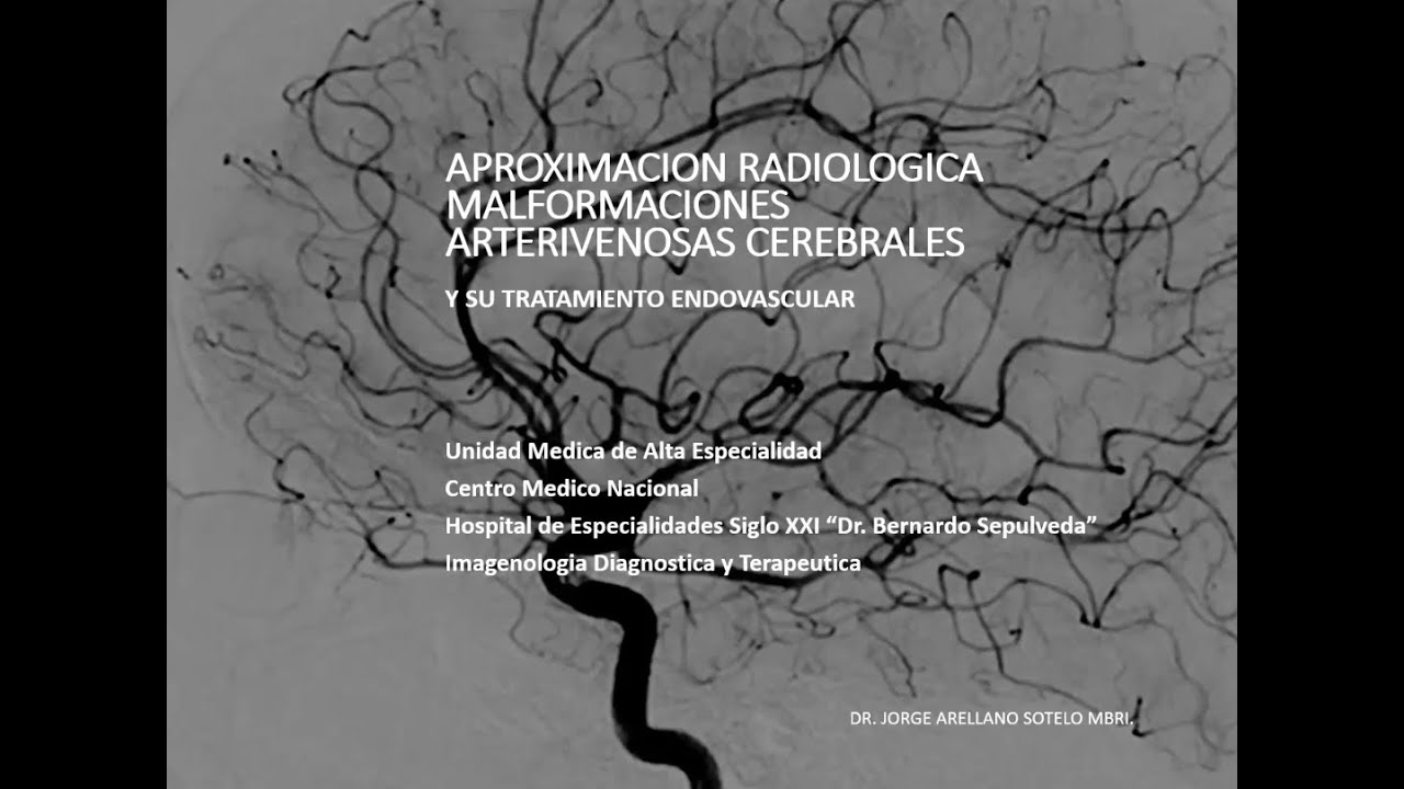 1-7 Manejo intervencionista de MAV cerebrales | Dr. Arellano - YouTube