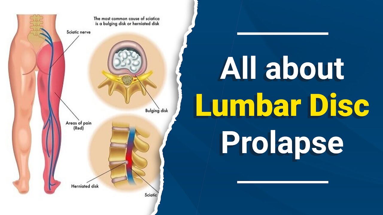 All about Lumbar Disc Prolapse | Dr. Rahul Chaudari | Spine Surgery in ...