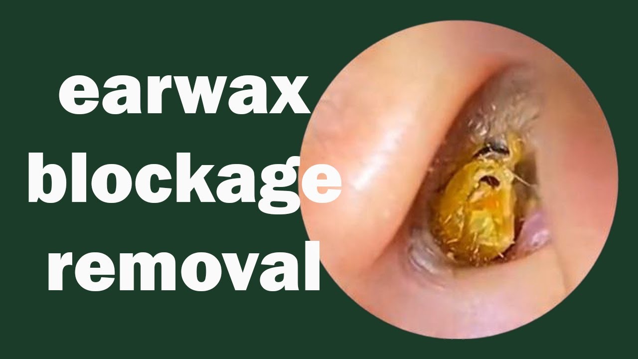 earwax blockage removal - YouTube