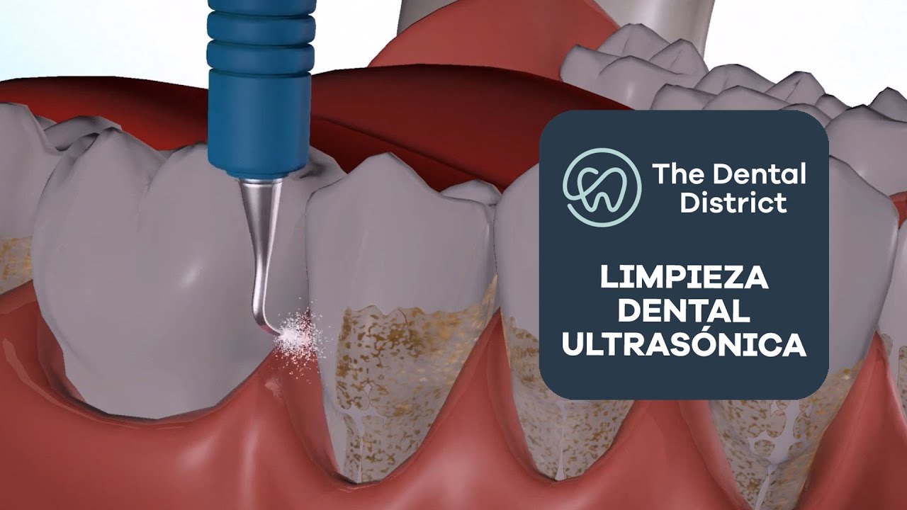 Consigue Dientes Limpios y Dientes Sanos con una Limpieza Dental ...