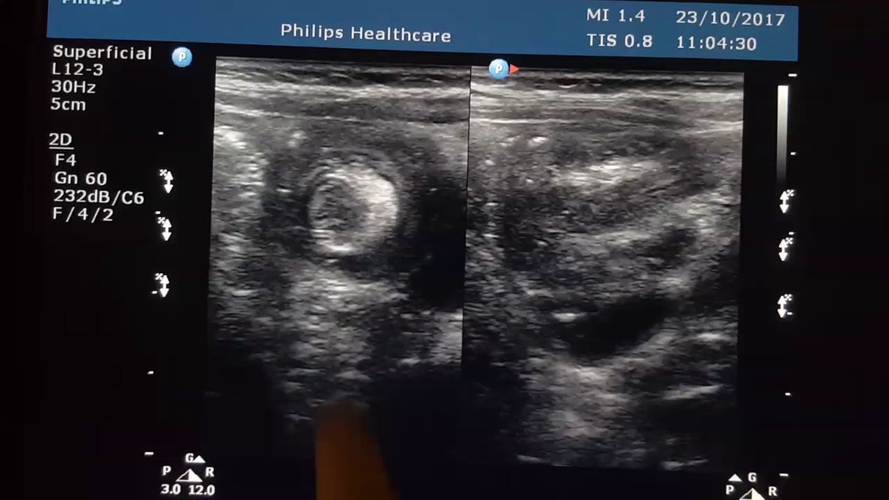Intussusception Sonography with Explanation - YouTube