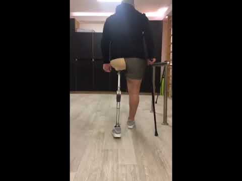 Réalisation à Medicpro d’une prothèse canadienne pour un jeune patient ...