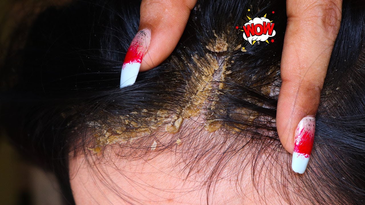 Scalp Big Dandruff #474 - YouTube