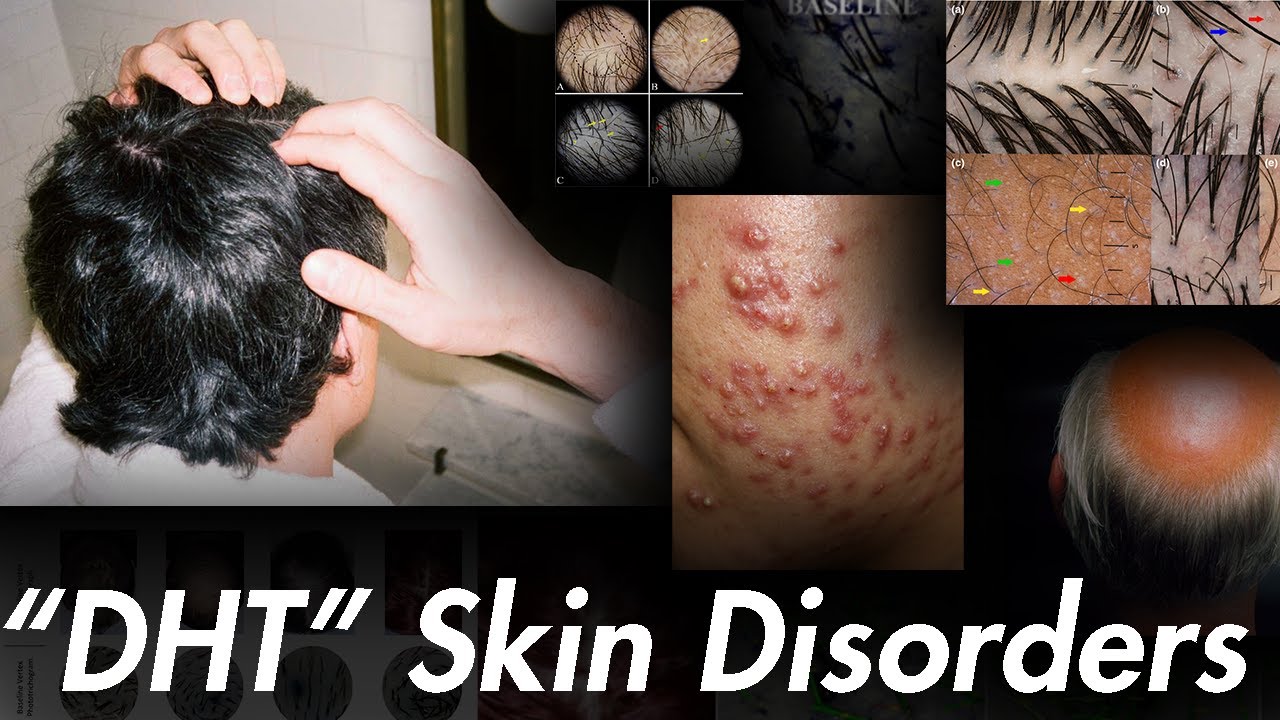 DHT Skin Disorders: Androgenetic Alopecia is a Skin Disease/Disorder ...