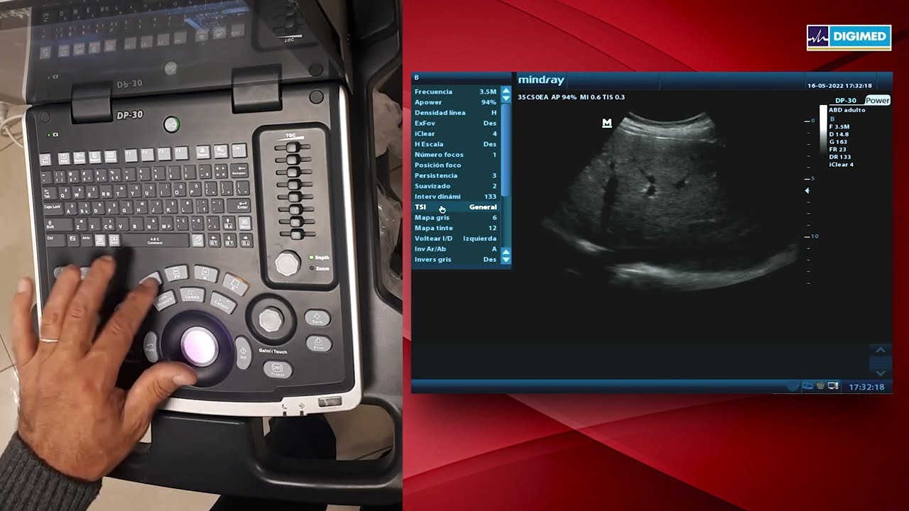 Mindray DP-30, introducción al funcionamiento del Power Doppler - YouTube