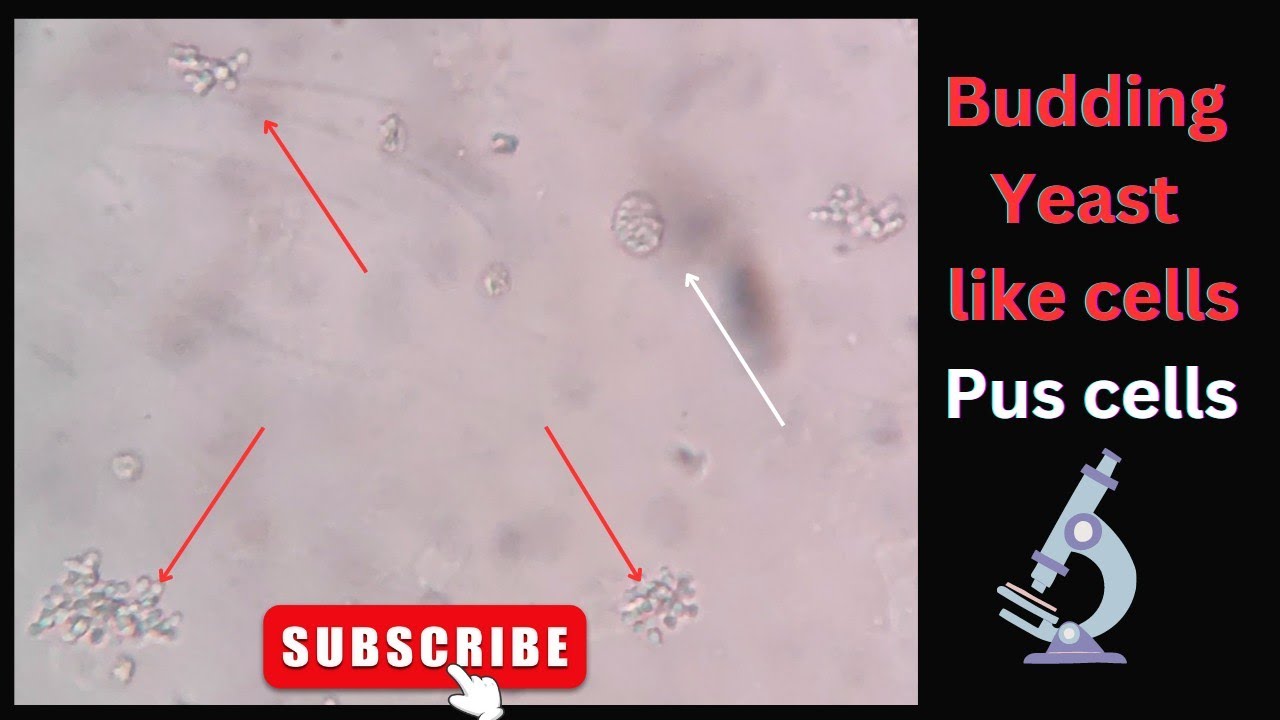 Yeast Cells In Urine Yeast Cells In Urine Specimens. Stock Photo