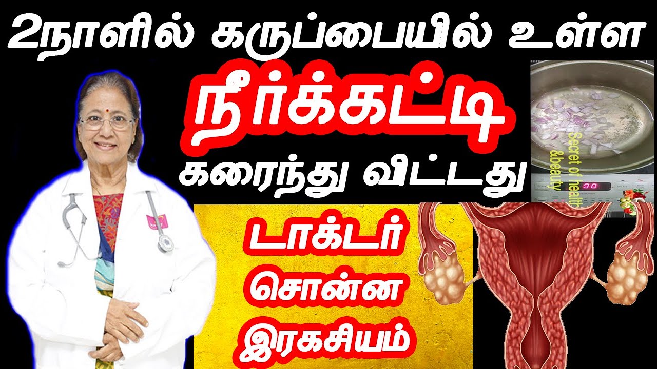 2நாளில் நீர்க்கட்டி கரைந்து விட்டது | neer katti karaiya | PCOD problem ...