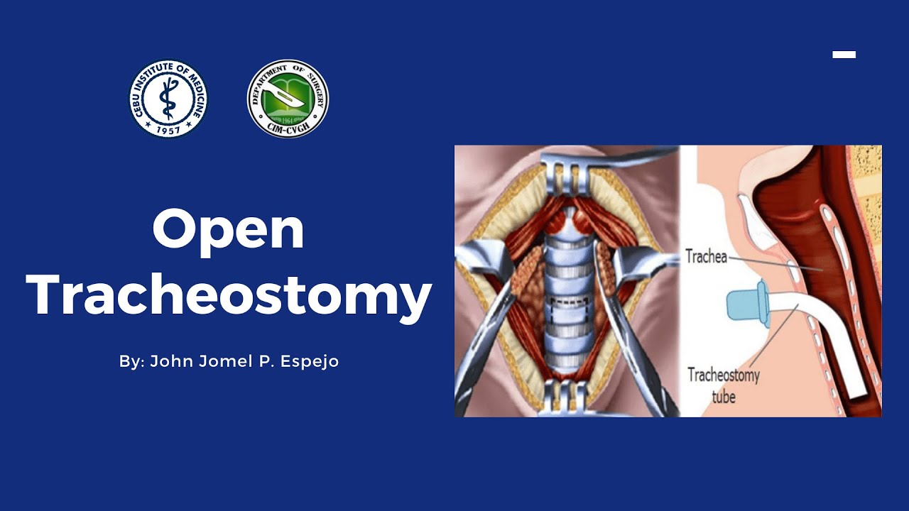 ESPEJO-OPEN TRACHEOSTOMY - YouTube