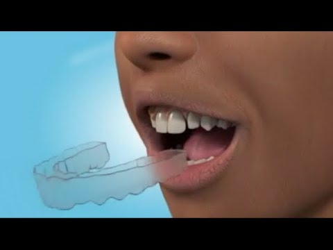 Vacuum Formed Retainer | RajanDental - YouTube