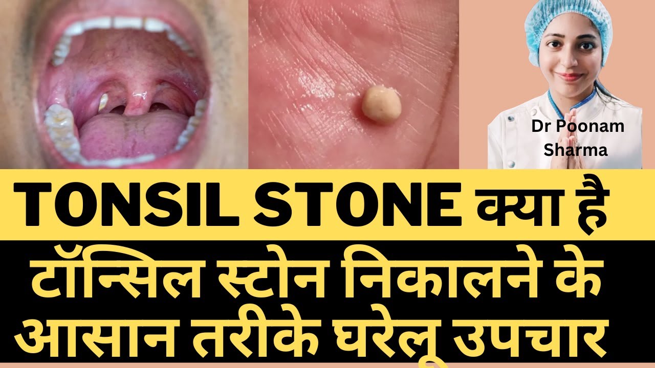 Tonsil Stone क्या है? | टॉन्सिल स्टोन निकालने के आसान घरेलू उपचार ...