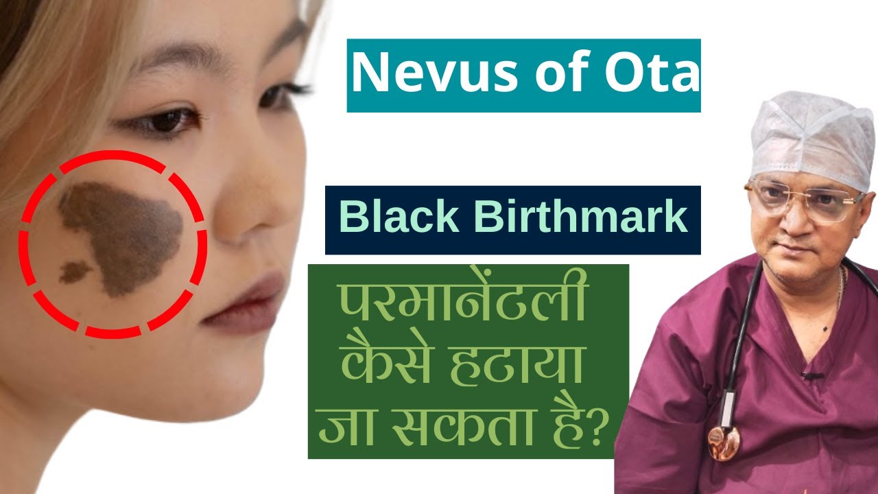Nevus of ota Treatment ऑपरेशन के बिना | Black Birthmark removal ...