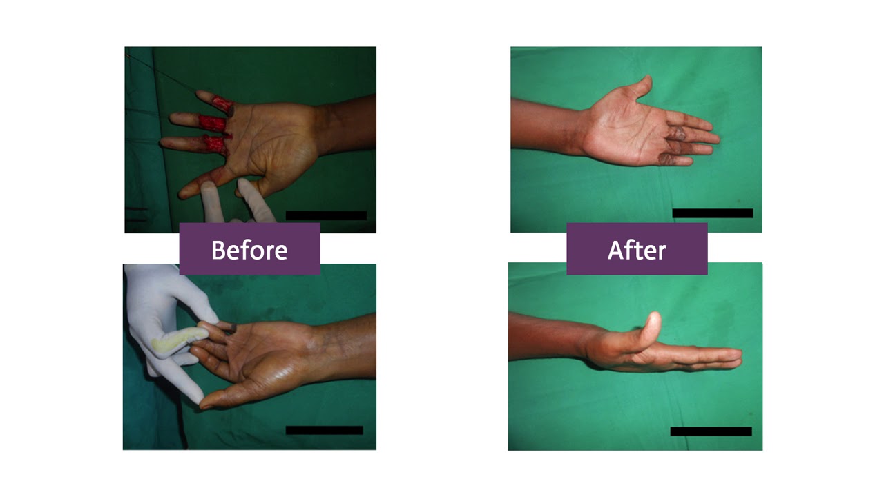 Post burn hand deformity surgery before/after | Cutis Hospital ...