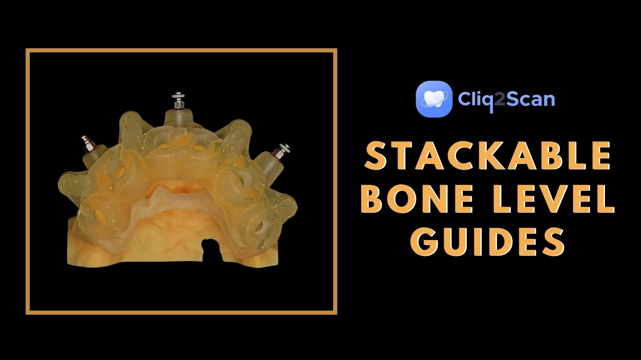 Stackable Surgical Guides for Total Extraction & Immediate Implants ...