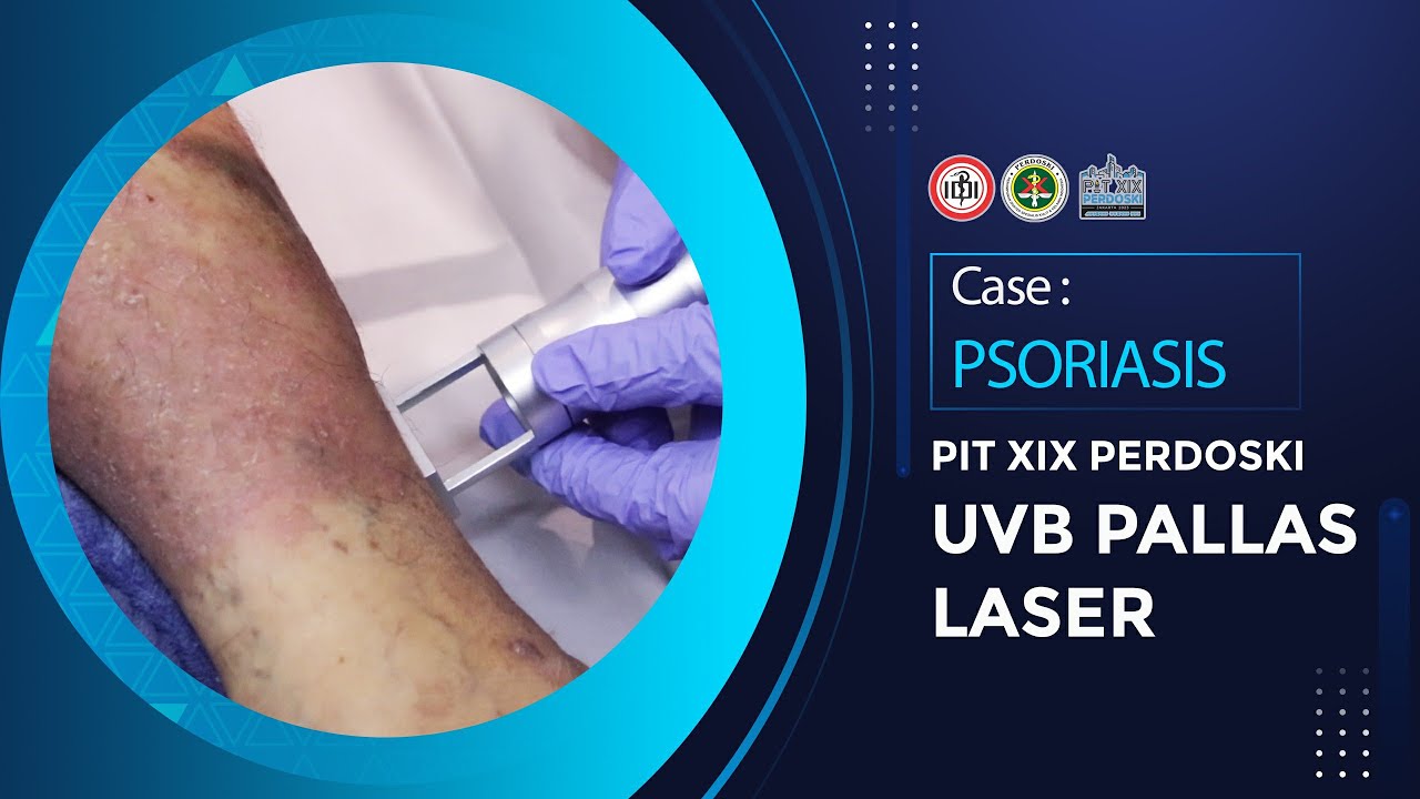 PIT XIX Perdoski Jakarta 2023 PALLAS LASER FOR PSORIASIS with dr ...