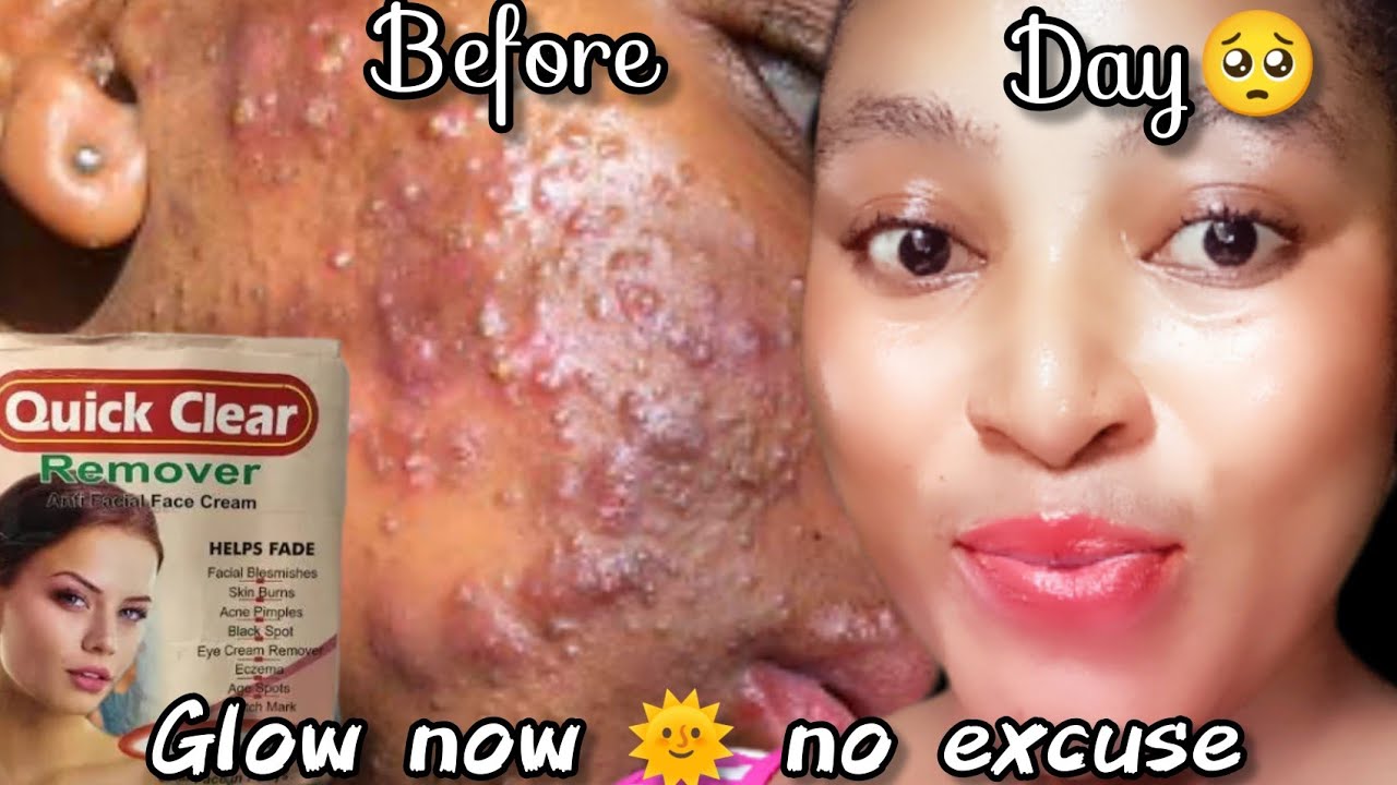in 2 days Quickly Get rid of Dark_spots! pimples Using:quick clear ...