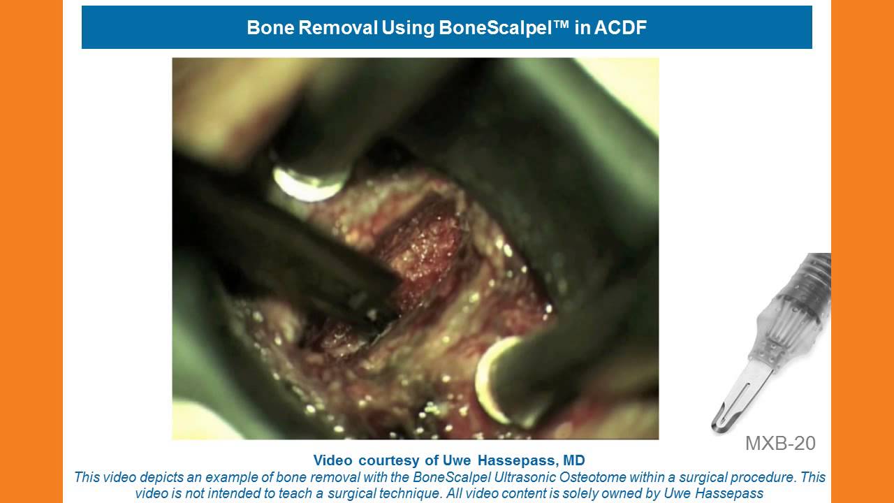 Anterior Cervical Discectomy and Fusion ACDF - YouTube
